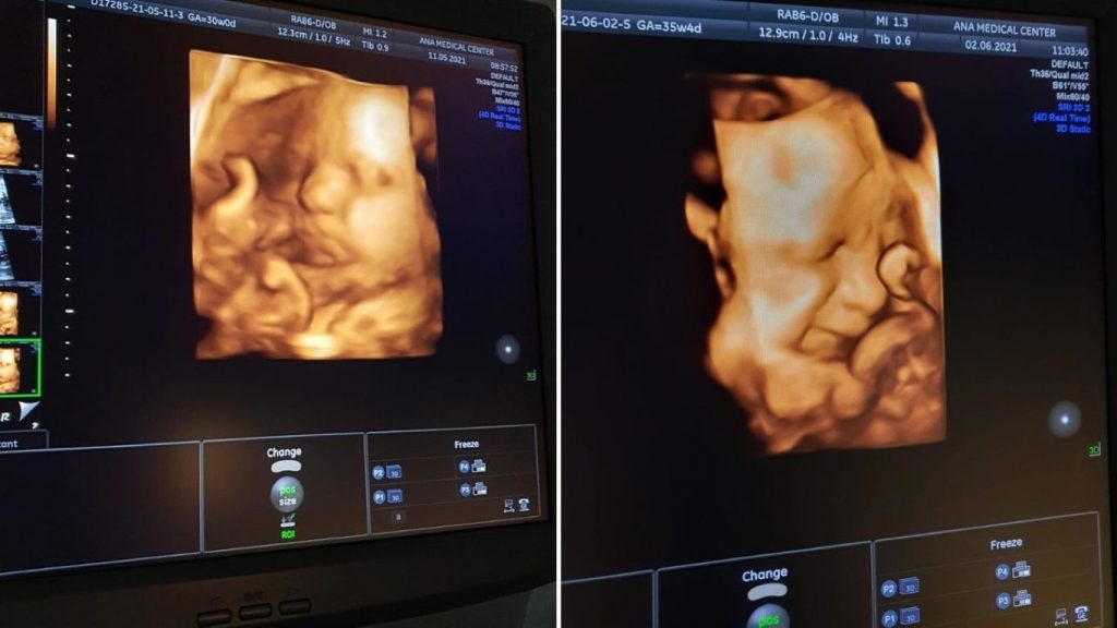 Cand se face morfologia fetala si de ce nu trebuie sa ratezi momentul